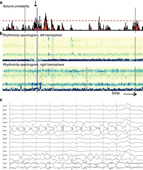 Qeeg In Seizure Detection Neupsy Key