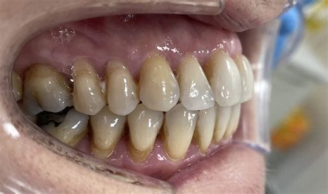 Case Gallery Clearcorrect