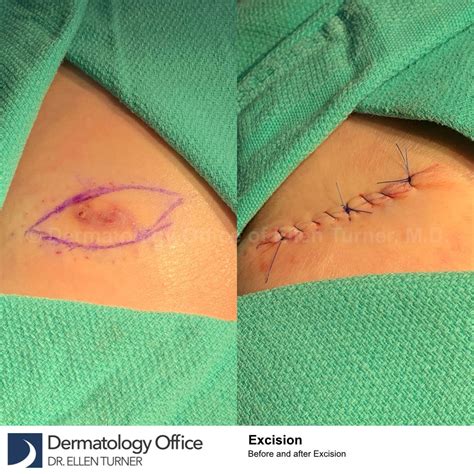 Dermatology 🔬 Expert Excision Procedure 🔬 See The Before And After