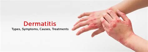 Dermatitis Demystified Everything You Need To Know Cmri