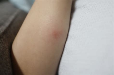 유아 몸에 피부 두드러기 약국 알러지 알레르기 약 세노바액 네이버 블로그