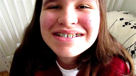 Braces Are On Youtube