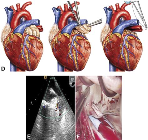 Left Atrial Appendage Occlusion Lessons Learned From Surgical And