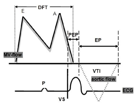 Schematic Mitral Valve And Aortic Doppler Flow Pattern And Ecg As