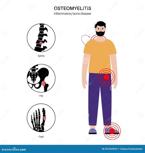 Osteomyelitis Of Feet Cartoon Vector 291792003