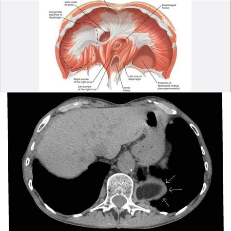 Are Bochdalek Hernias Common Right Sided Bochdalek Hernia In An