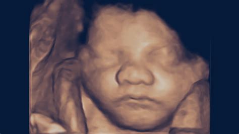3d Ultrasound In Toronto Pockethealth