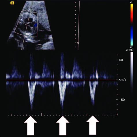Pulsed Wave Doppler Evaluation Of Mitral Valve Inflow The Doppler