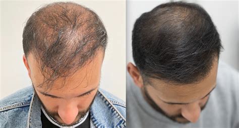 Irfans Laser Hair Growth Treatment Before And After Photos Este Medical