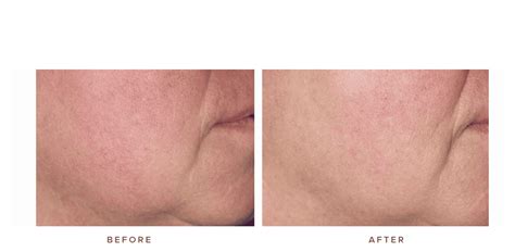 Laser Genesis Sydney Laser Resurfacing Infinity Skin Clinic