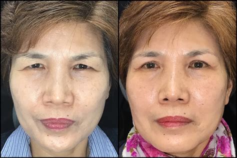 Before And After Photos Case 254671 Dr Kristin J Tarbet