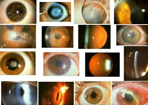 Fleck Corneal Dystrophy