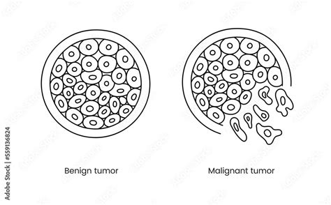 Benign Vs Malignant Cells Benign Vs Malignant Cells
