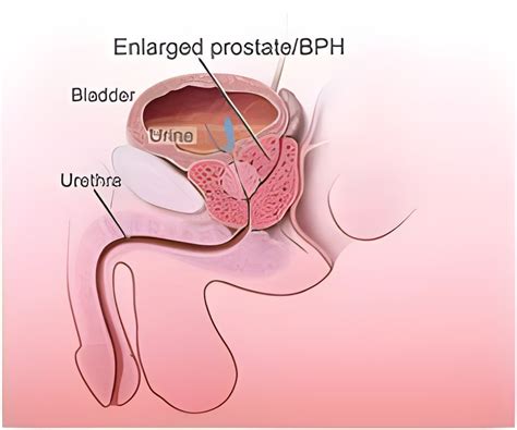 Enlarged Prostate Enlarged Prostate Vascular And Interventional Centre