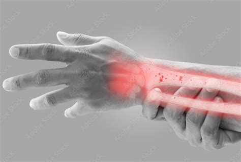 Osteogenesis Imperfecta Causes Symptoms And Prevention Tips Myhealthopedia