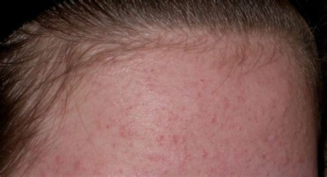 Skin Lesions Scalp Lesions Pustular Extensive Erosions Quiz Case