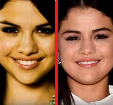 Selena Gomez Plastic Surgery Transformation Plastic Surgery Magazine