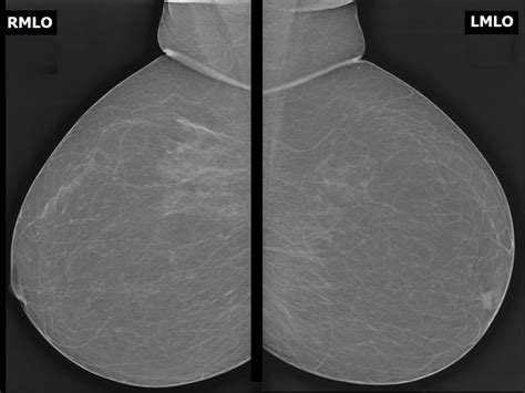 Atlas Of Breast Cancer Early Detection