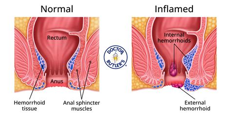 External Vs Internal Hemorrhoids Whats The Difference Doctor Butlers