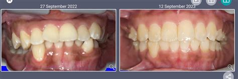 Tray 18 33 R Invisalign