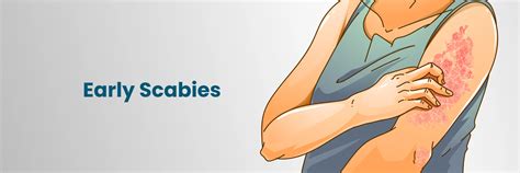 Scabies Prevention