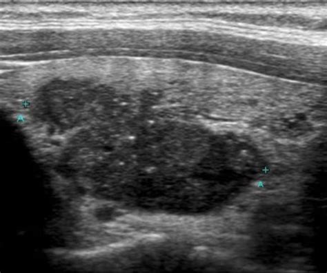 Thyroid Ultrasound For Papillary Thyroid Cancer