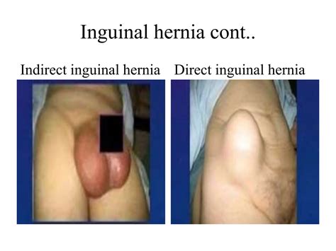 Hernia Classification Of Hernias In Different Forms Ppt