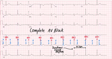 Av Nodal Junctional Rhythm