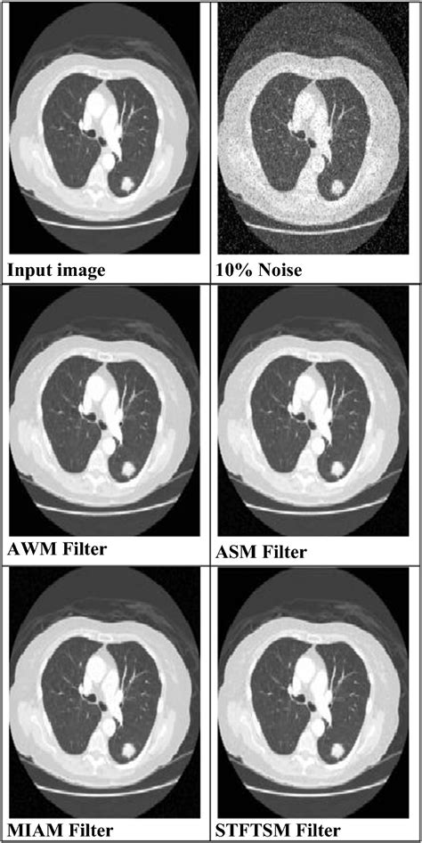 Denoising Outputs For 10 Noise Corruption On Lidc Db 1 Image