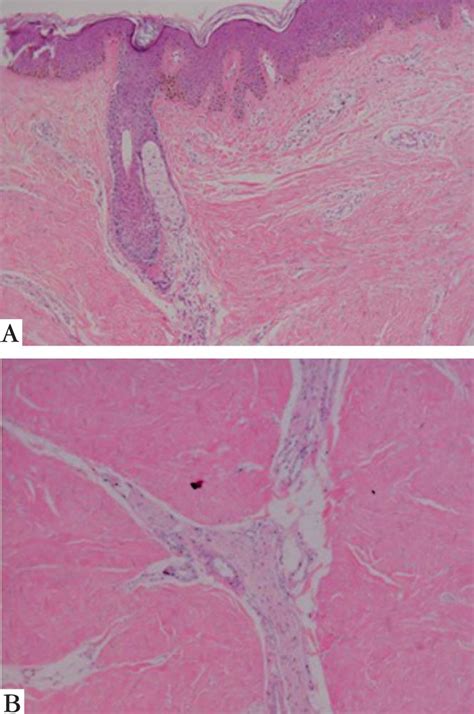 Systemic Sclerosis With Keloidal Nodules Abstract Europe Pmc