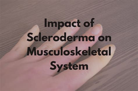 The Impact Of Scleroderma On Musculoskeletal System