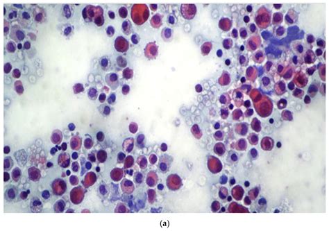 Bringing Ai To Clinicians Simplifying Pleural Effusion Cytology