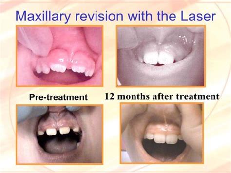 Maxillary
