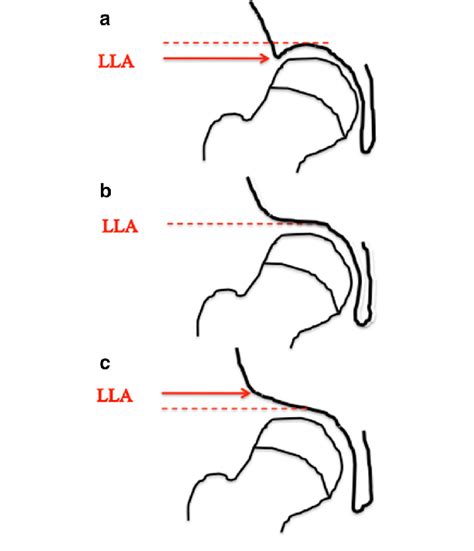 Schematic Illustration Of The Lateral Acetabular Inclination The Download Scientific Diagram