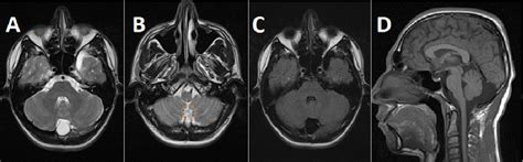 Is It An Arachnoid Cyst Or A Mega Cisterna Magna What To And Where To