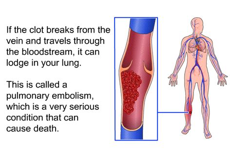 Preventing Deep Vein Thrombosis