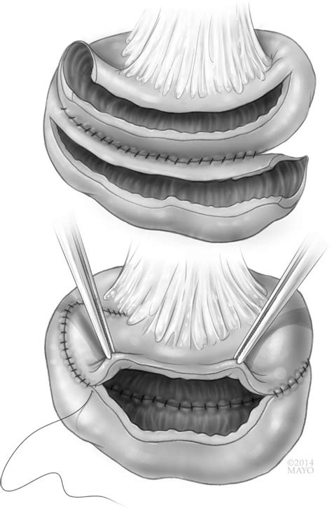Surgery For Crohn Disease Personalizing The Operation Clinical Tree