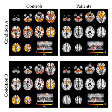 Statistical Parametric Maps Of Regions Of Greatest Activation For Each Download Scientific