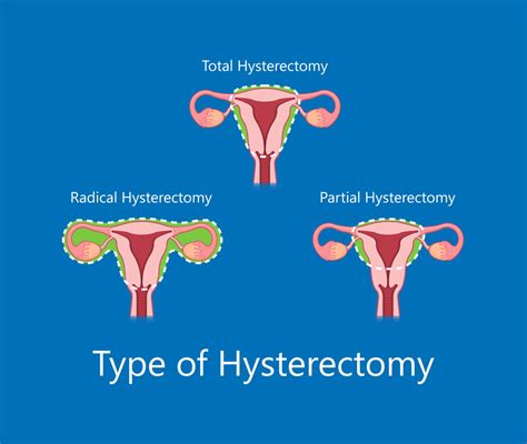 Myomectomy Vs Hysterectomy Which Is Right For You New York City 1 Fibroid Center
