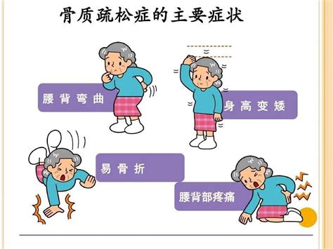 世界骨质疏松日预防不能光靠补钙 运动锻炼作用大 骨质疏松 骨科 骨折 新浪新闻