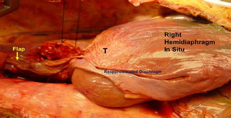 Thoracic View Of The Right Hemidiaphragm In Situ In A Cadaver