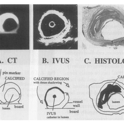 Schematic Of Ivus Catheter Within Blood Vessel Cross Sectional Imaging