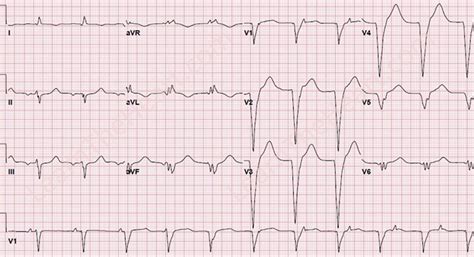 Idioventricular Rhythms Ecg Review Criteria And Examples