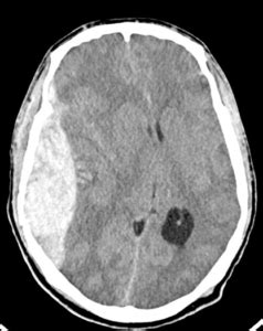 Epidural Hematoma Ct Scan