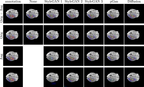 Brain Tumor Segmentation Using Synthetic Mr Images A Comparison Of