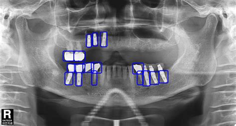 Deep Learning Object Detection On Dental X Rays Clement Joudet Blog