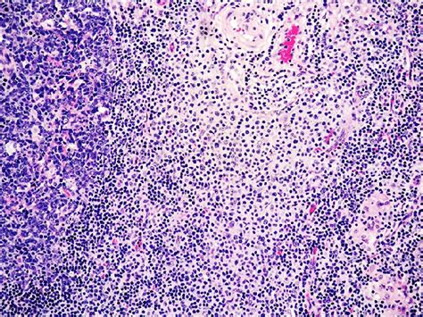 Medium Power View Of Lymph Node Showing A Reactive Germinal Center Download Scientific Diagram
