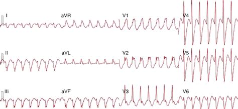 Bundle Branch Reentrant Ventricular Tachycardia Bbrvt Ecg