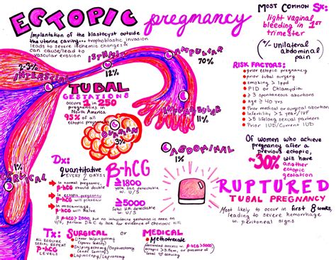 Emergency Medicine Educationobcast Ectopic Pregnancy