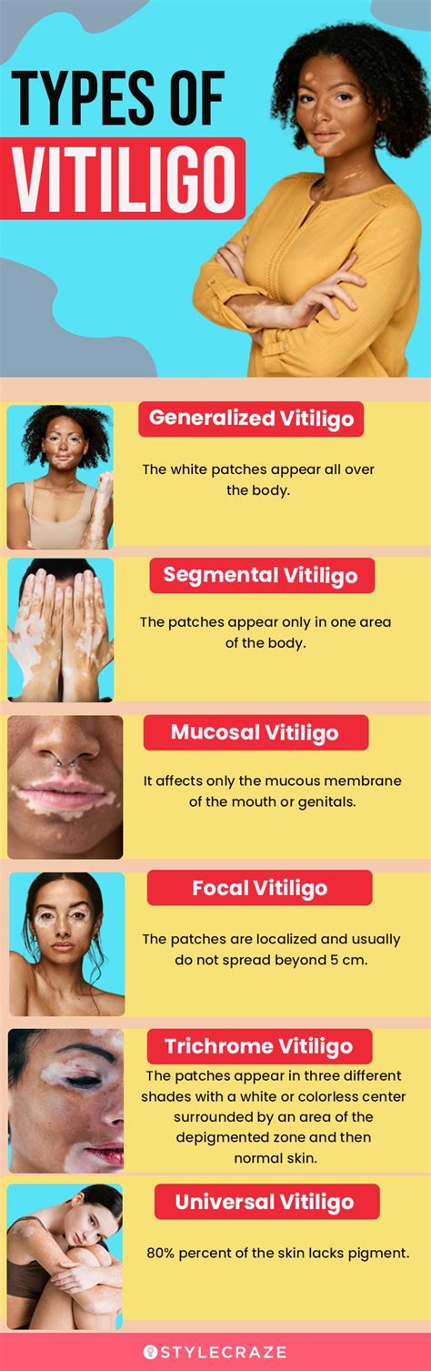 Vitiligo Modell